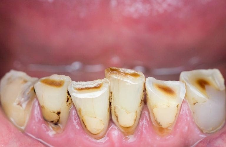 Rotten Teeth Treatment Hoppers Crossing | Connect Dental Care